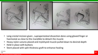 Vestibuloplasty- ridge extension procedures | PPTX