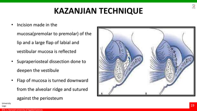 Vestibuloplasty- ridge extension procedures | PPT