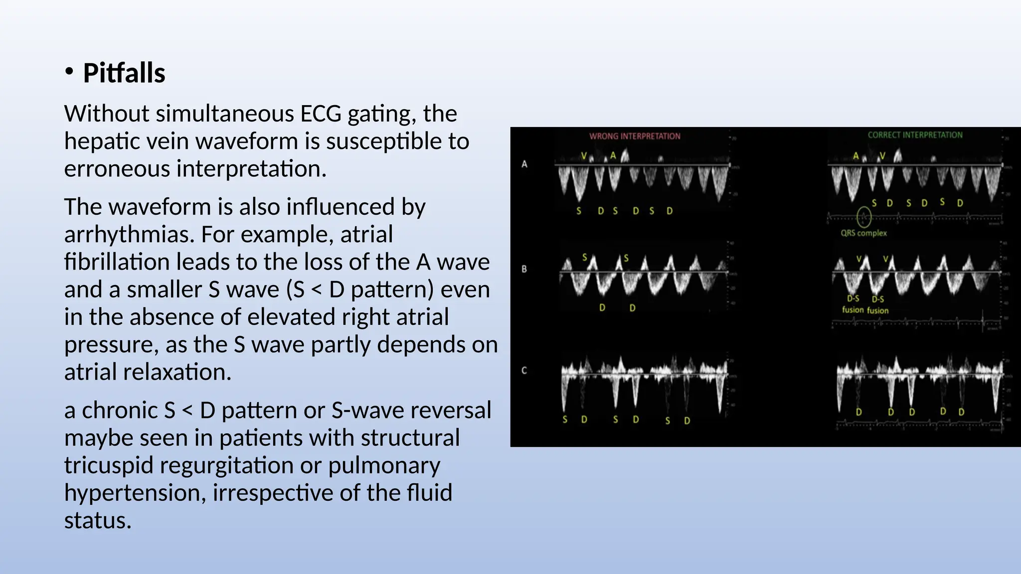 Venous Excess Ultrasound Score For venous congestion | PPTX