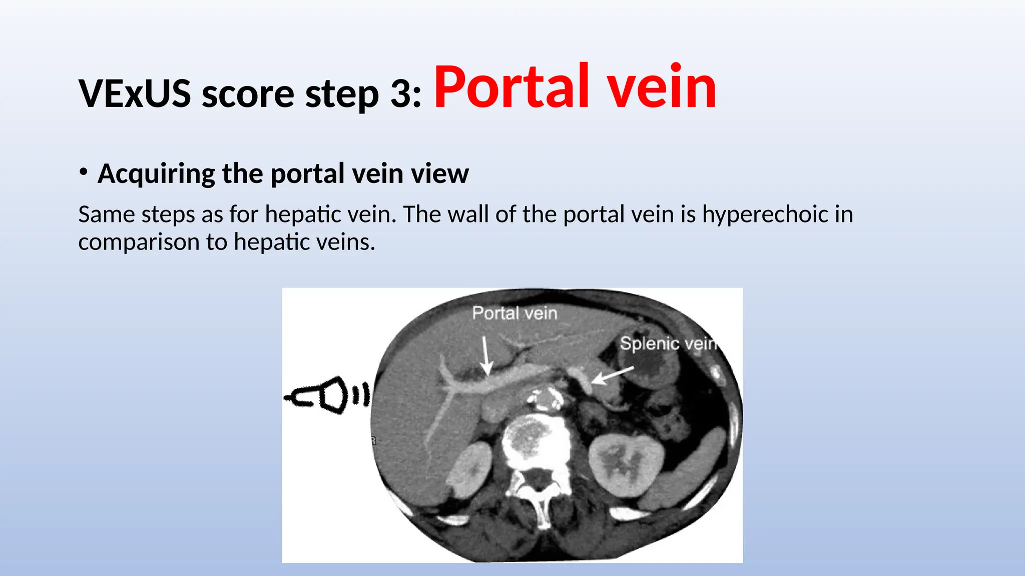 Venous Excess Ultrasound Score For venous congestion | PPTX