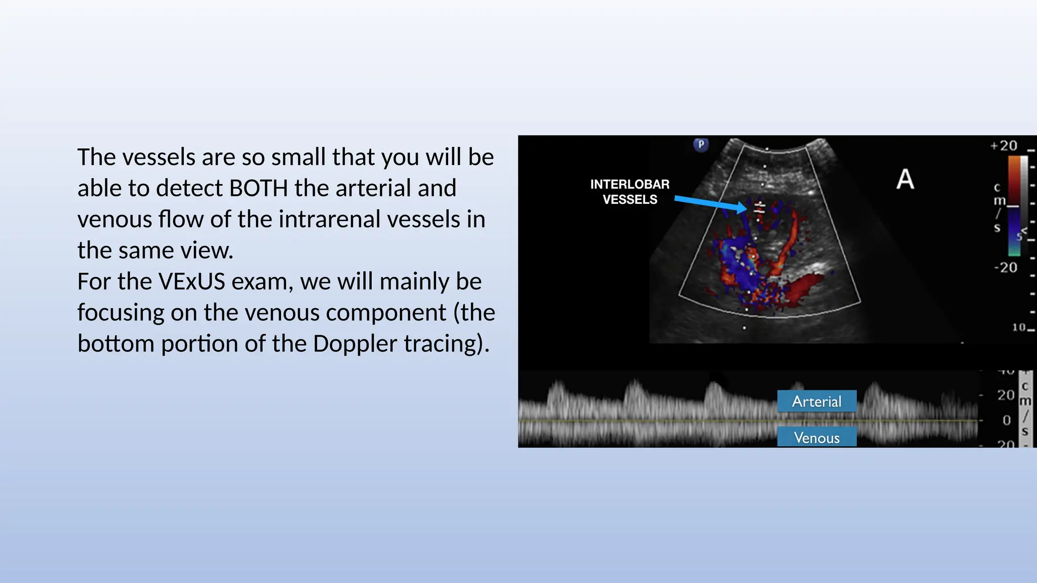 Venous Excess Ultrasound Score For venous congestion | PPTX