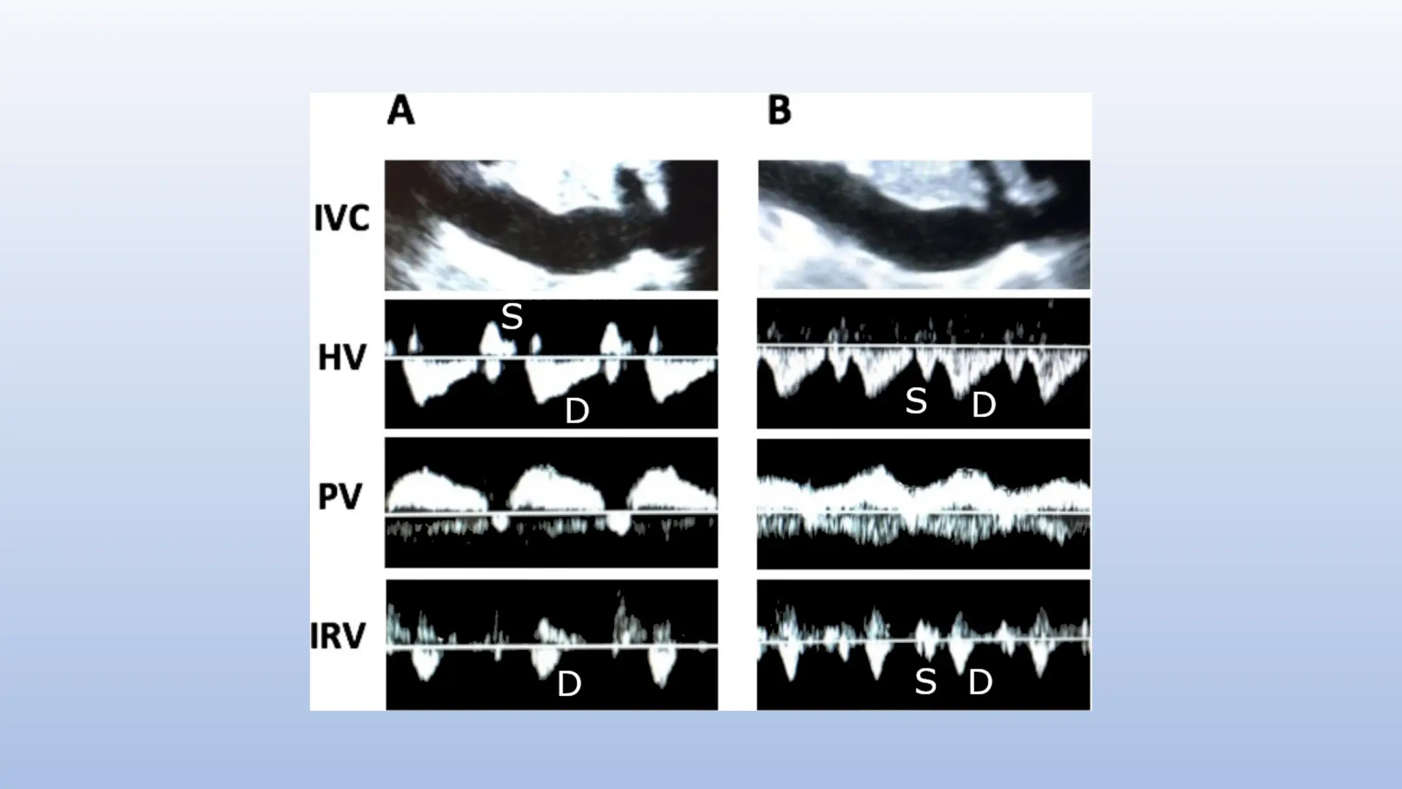 Venous Excess Ultrasound Score For venous congestion | PPTX