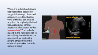 Venous Excess Ultrasound Score For venous congestion | PPTX