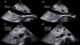 Venous Excess Ultrasound Score For venous congestion | PPTX