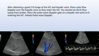 Venous Excess Ultrasound Score For venous congestion | PPTX