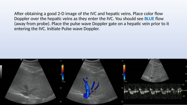 Venous Excess Ultrasound Score For venous congestion | PPTX | Heart and ...