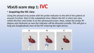 Venous Excess Ultrasound Score For venous congestion | PPTX