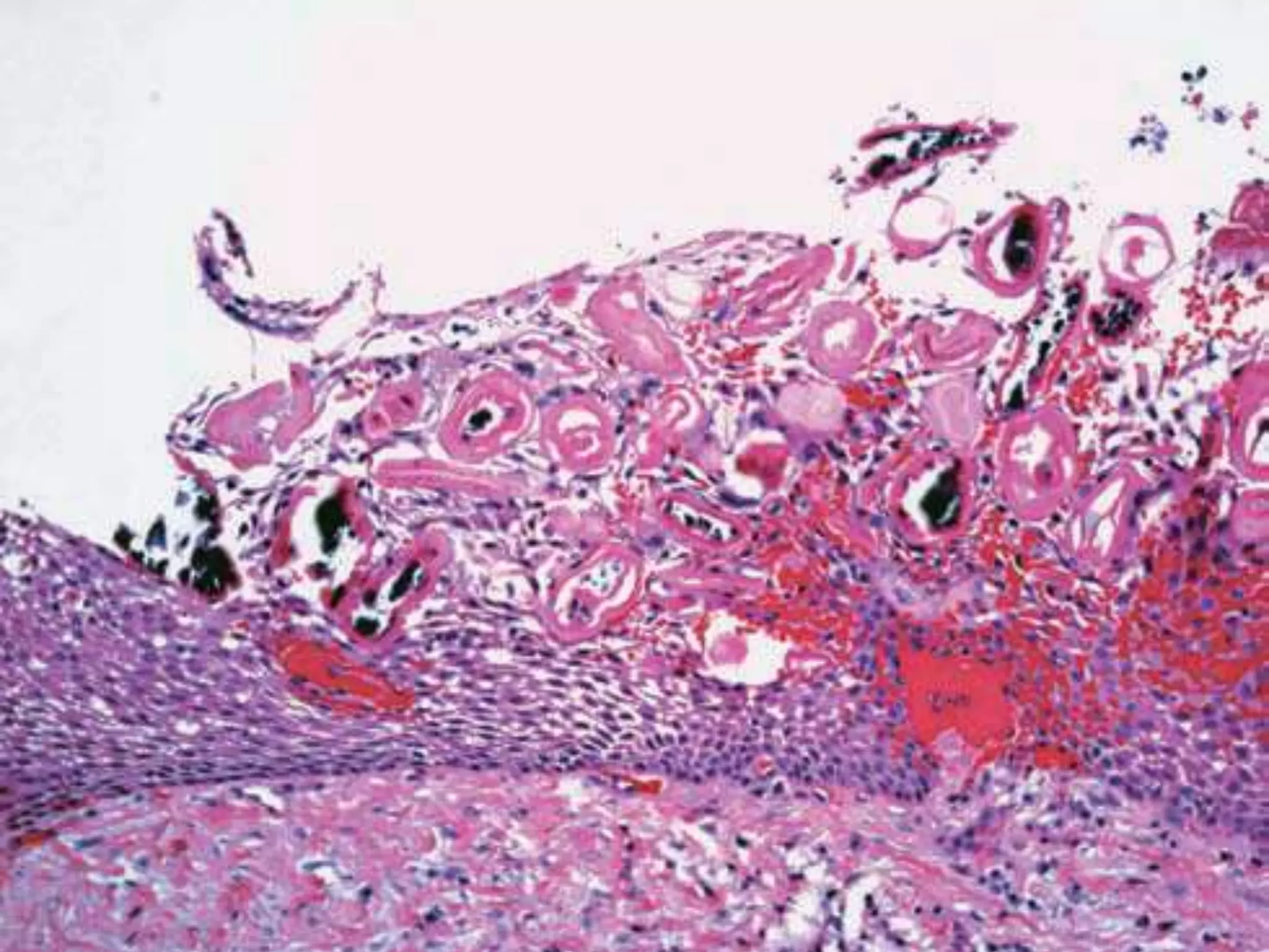 Cysts of jaws pathogenesis | PPTX