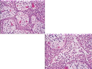 Globulomaxillary Cyst Histology