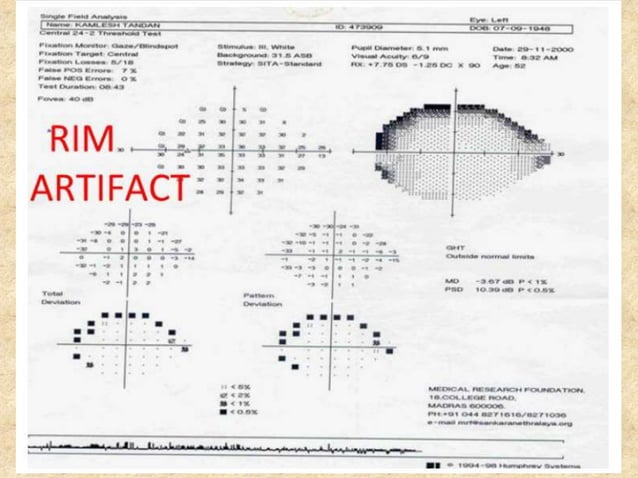 visual field analysis | PPTX | Eye and Vision Conditions | Diseases and ...