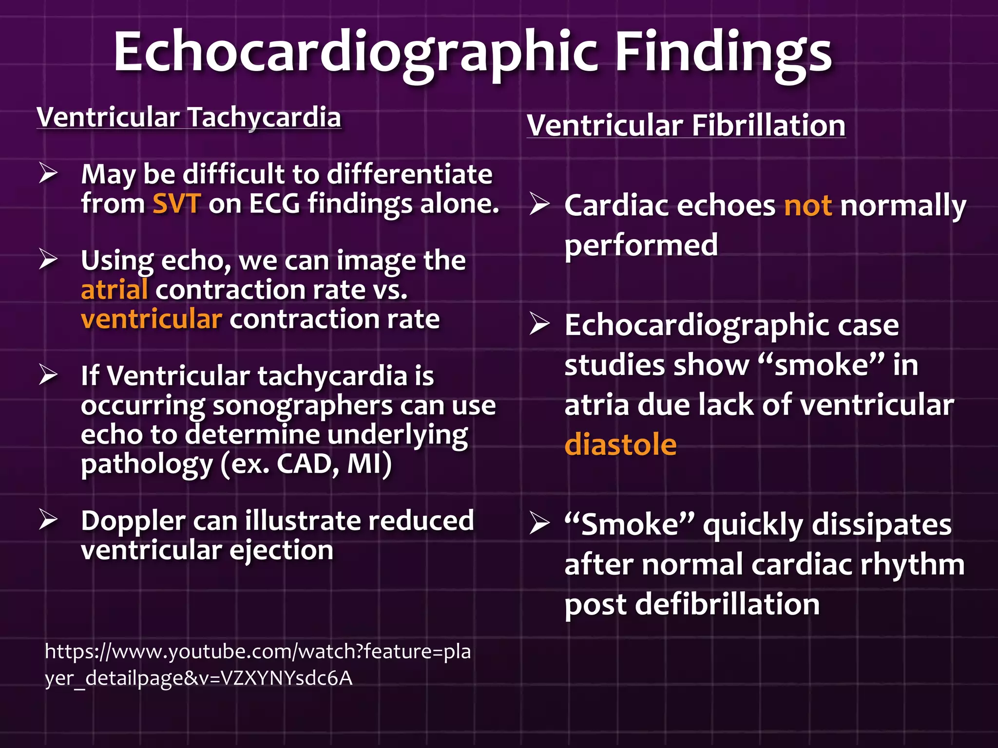 Ventricular Tachycardia and Ventricular Fibrillation Presentation | PPTX