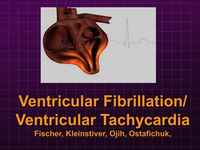 Ventricular Tachycardia and Ventricular Fibrillation Presentation | PPTX