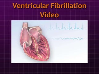 Ventricular Tachycardia and Ventricular Fibrillation Presentation | PPTX