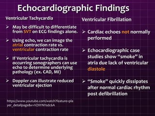 Ventricular Tachycardia and Ventricular Fibrillation Presentation | PPTX