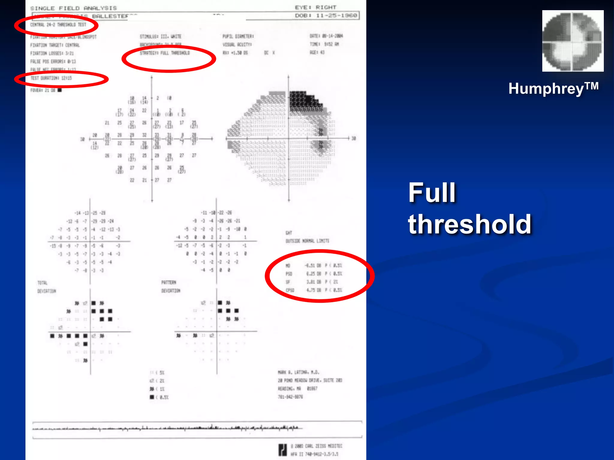 Visual Field in Glaucoma | PDF