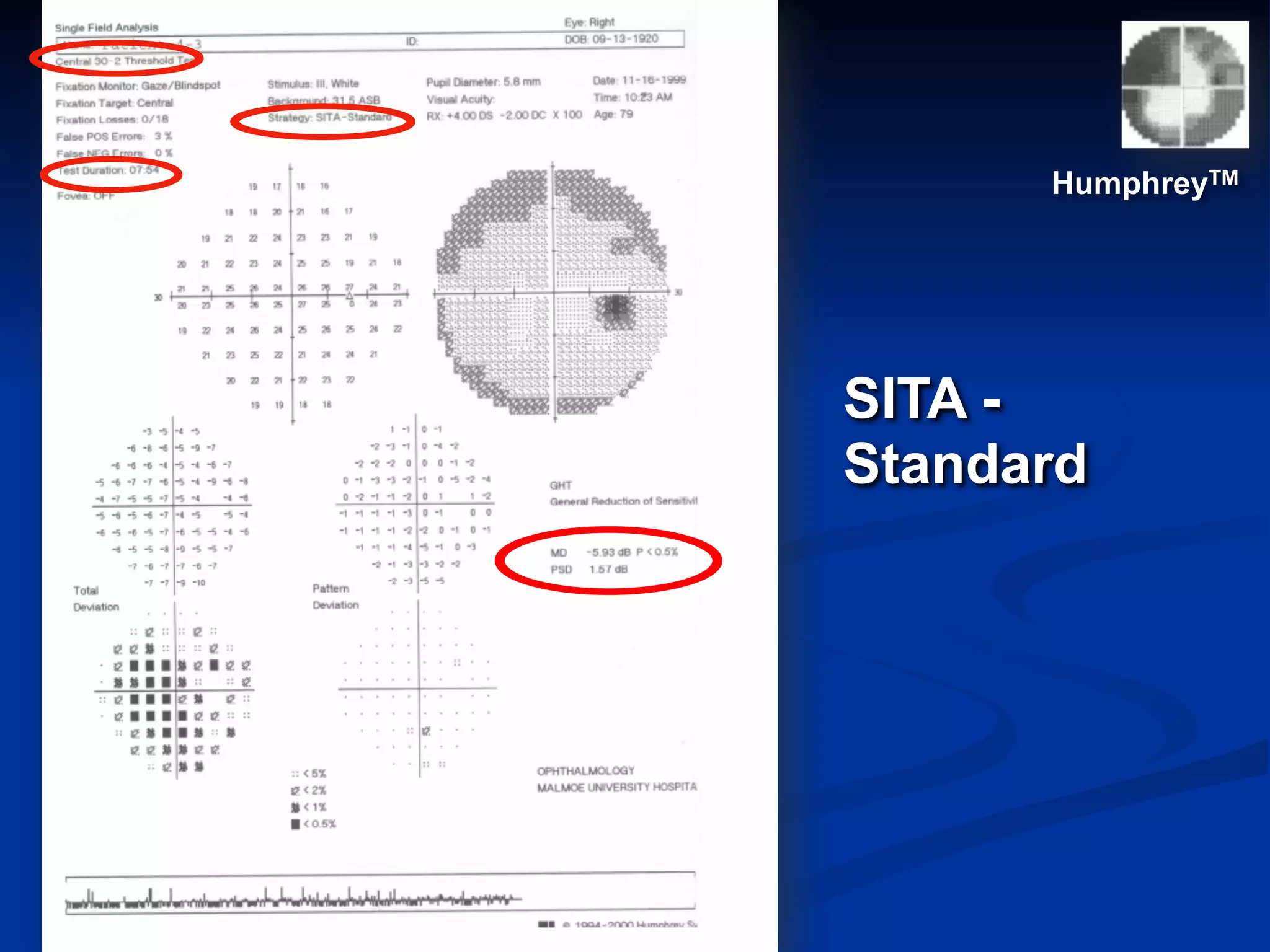 Visual Field in Glaucoma | PDF