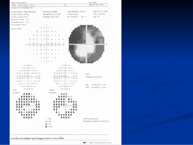 Visual Field in Glaucoma