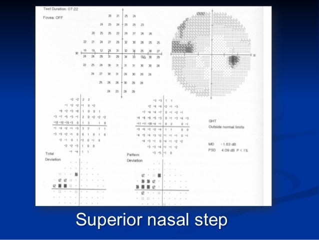 Visual Field in Glaucoma