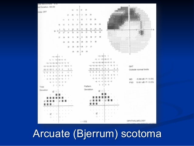 Visual Field in Glaucoma