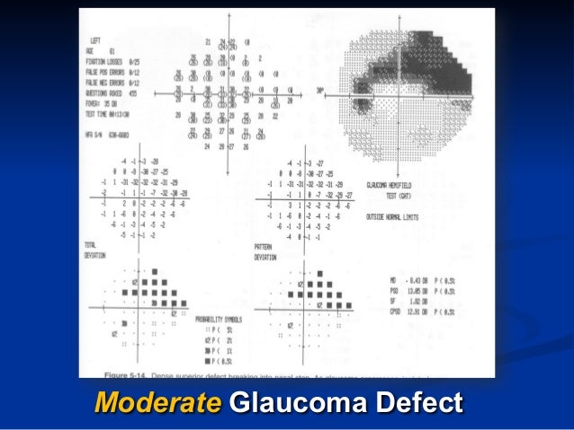 Visual Field in Glaucoma