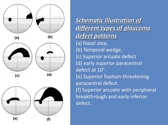 VF in glaucoma.pptx
