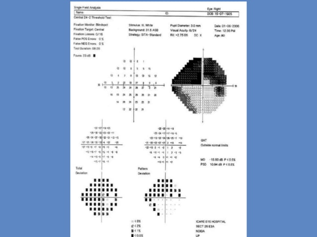 VF in glaucoma.pptx