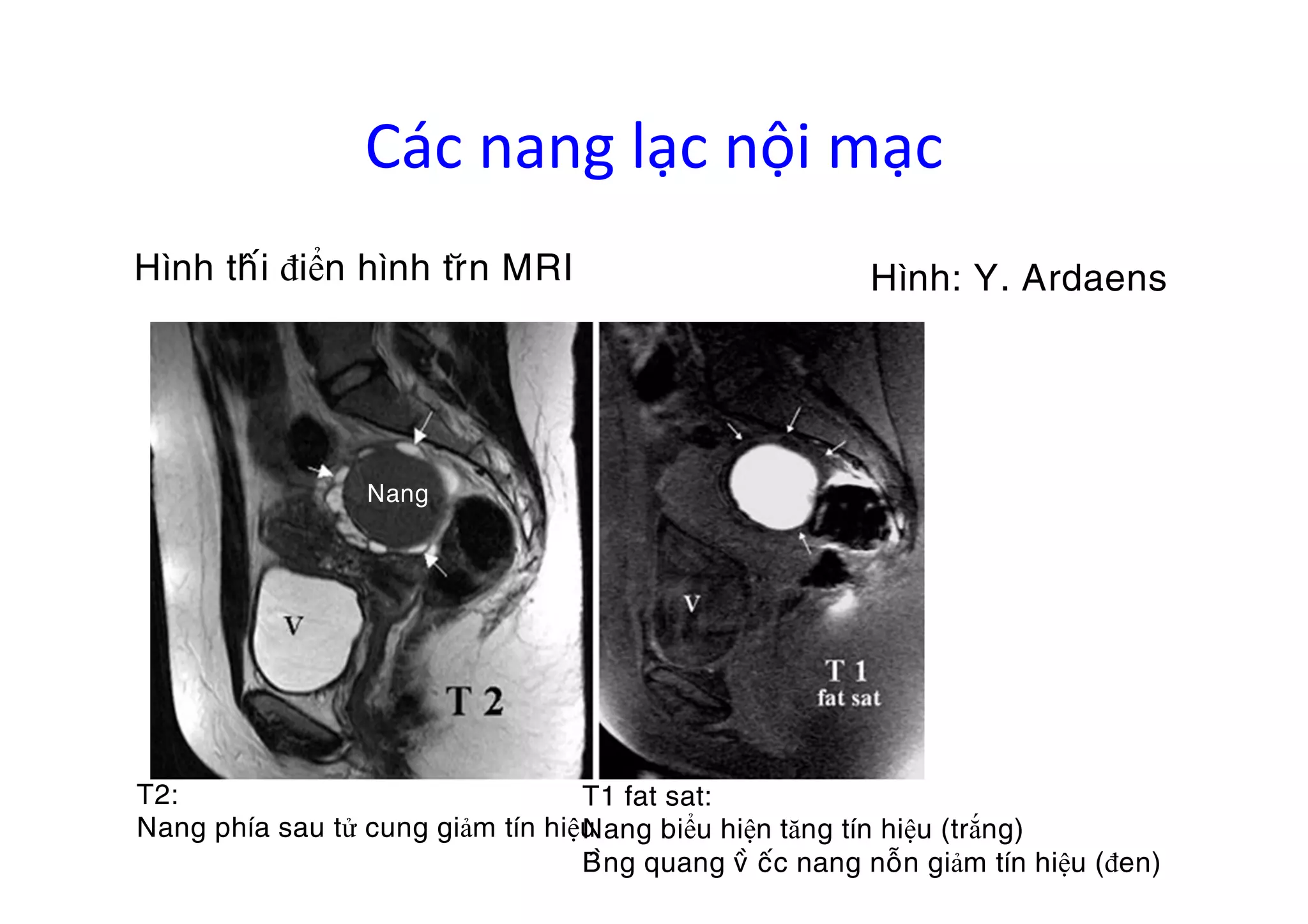 CHẨN ĐOÁN LẠC NỘI MẠC TỬ CUNG | PDF