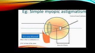 Technique of Jackson cross cylinder | PPTX