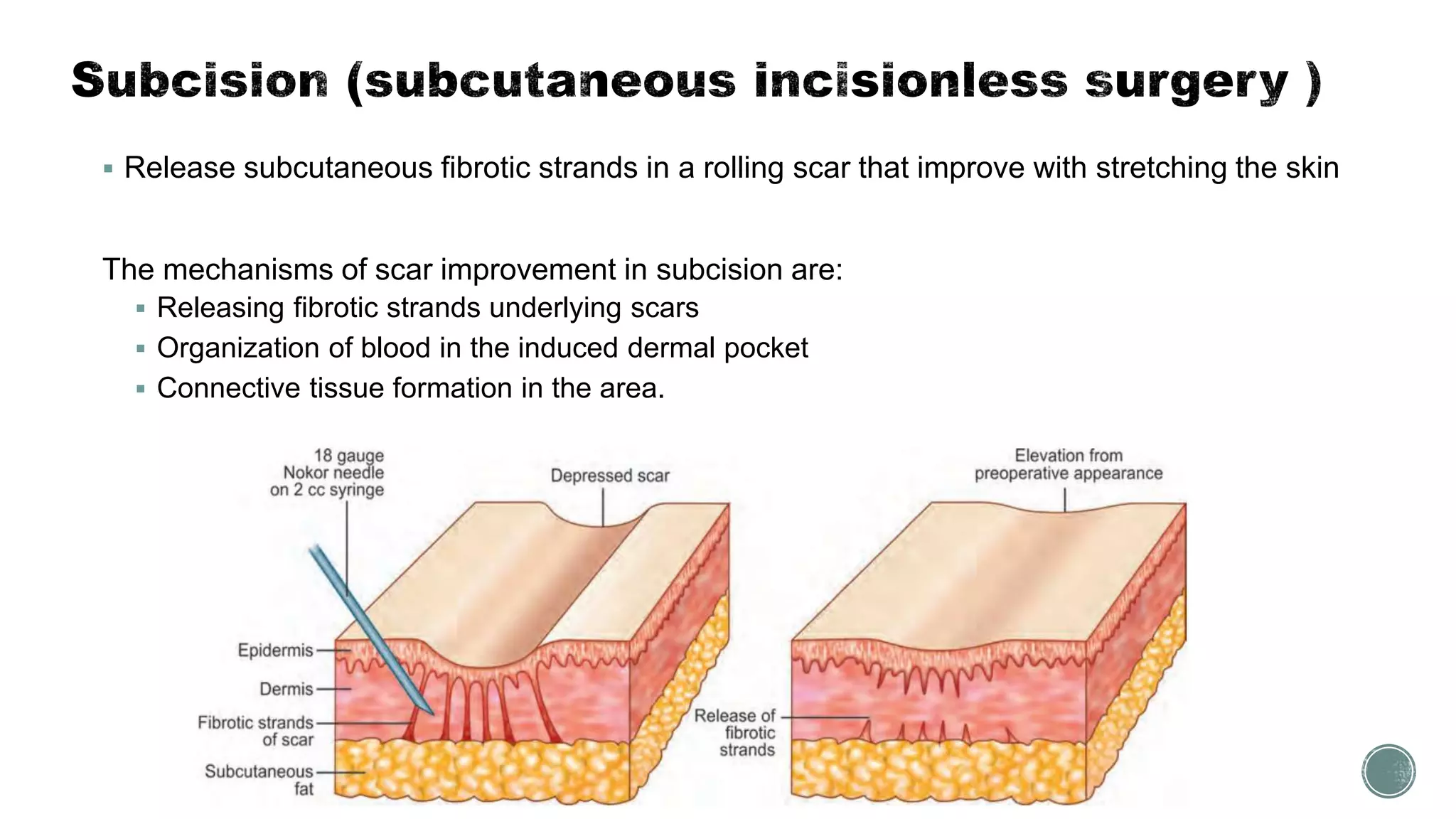 Acne scar management | PPTX