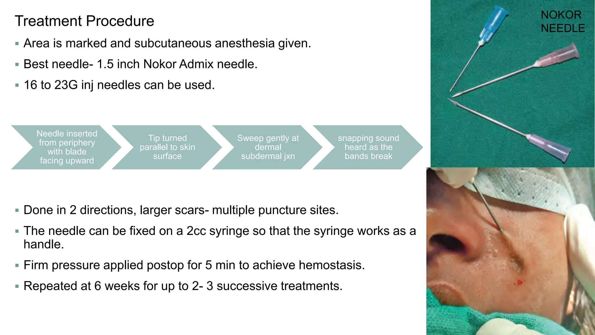 Acne scar management | PPTX