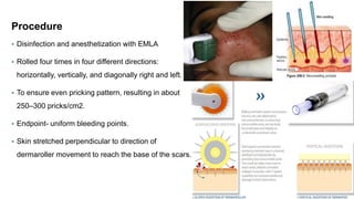 Acne scar management | PPTX
