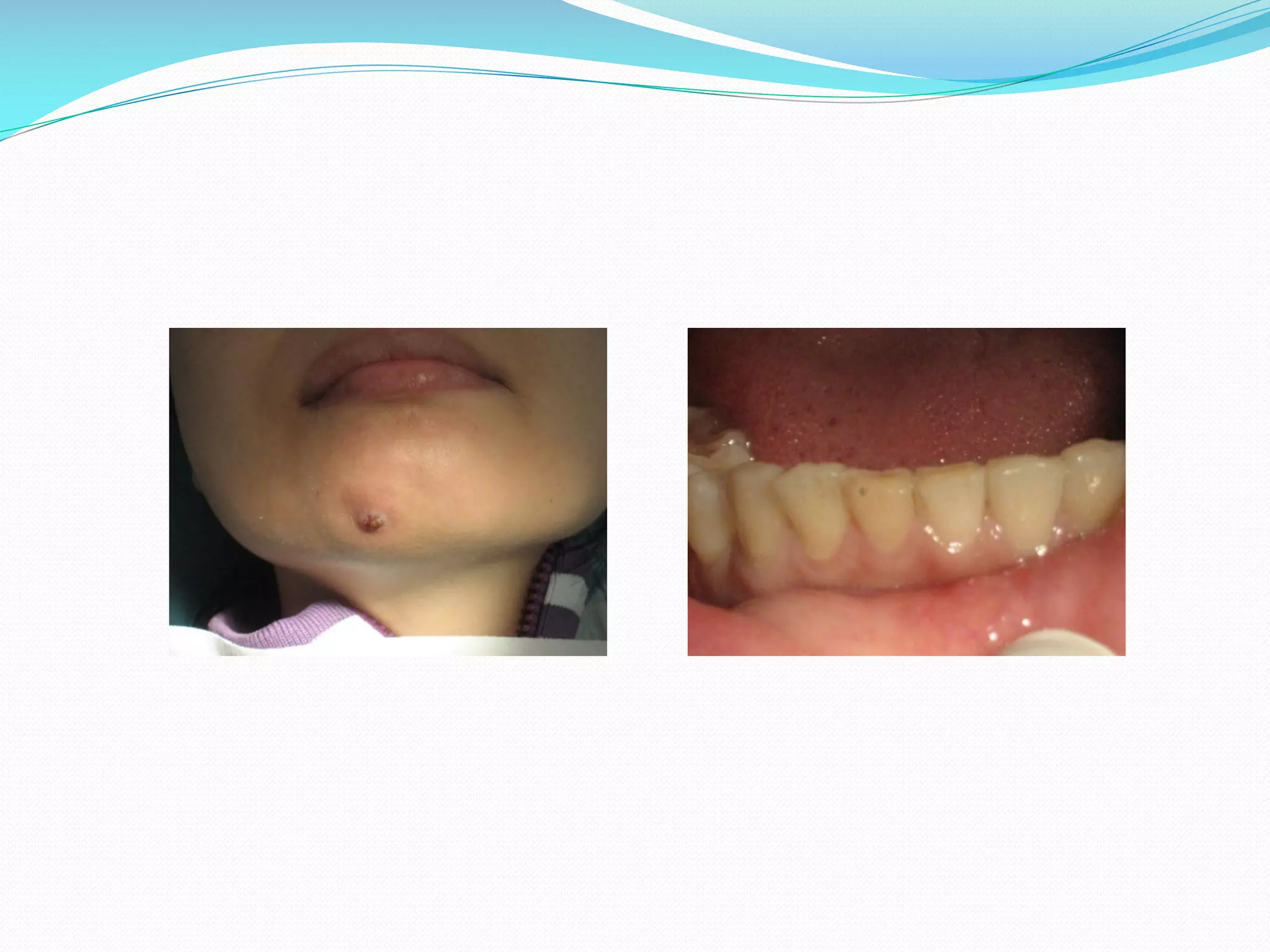 BỆNH LÝ TỦY VÀ VÙNG QUANH CHÓP | PDF