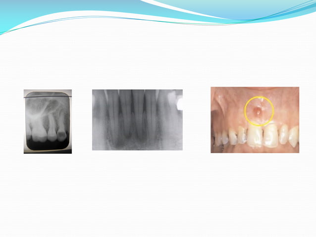 BỆNH LÝ TỦY VÀ VÙNG QUANH CHÓP | PDF