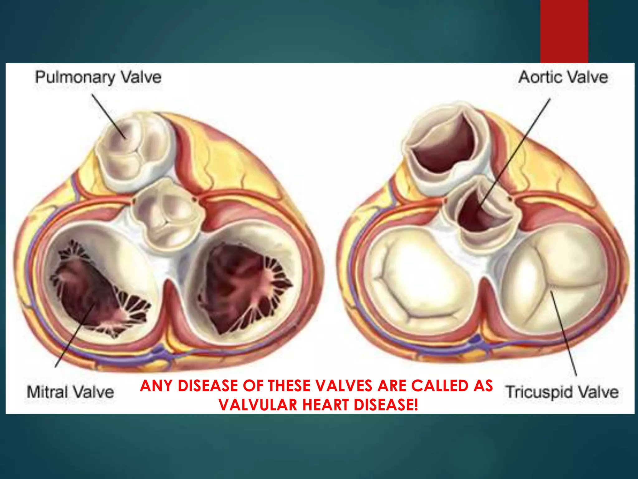 VALVULAR HEART DISEASE | PPTX