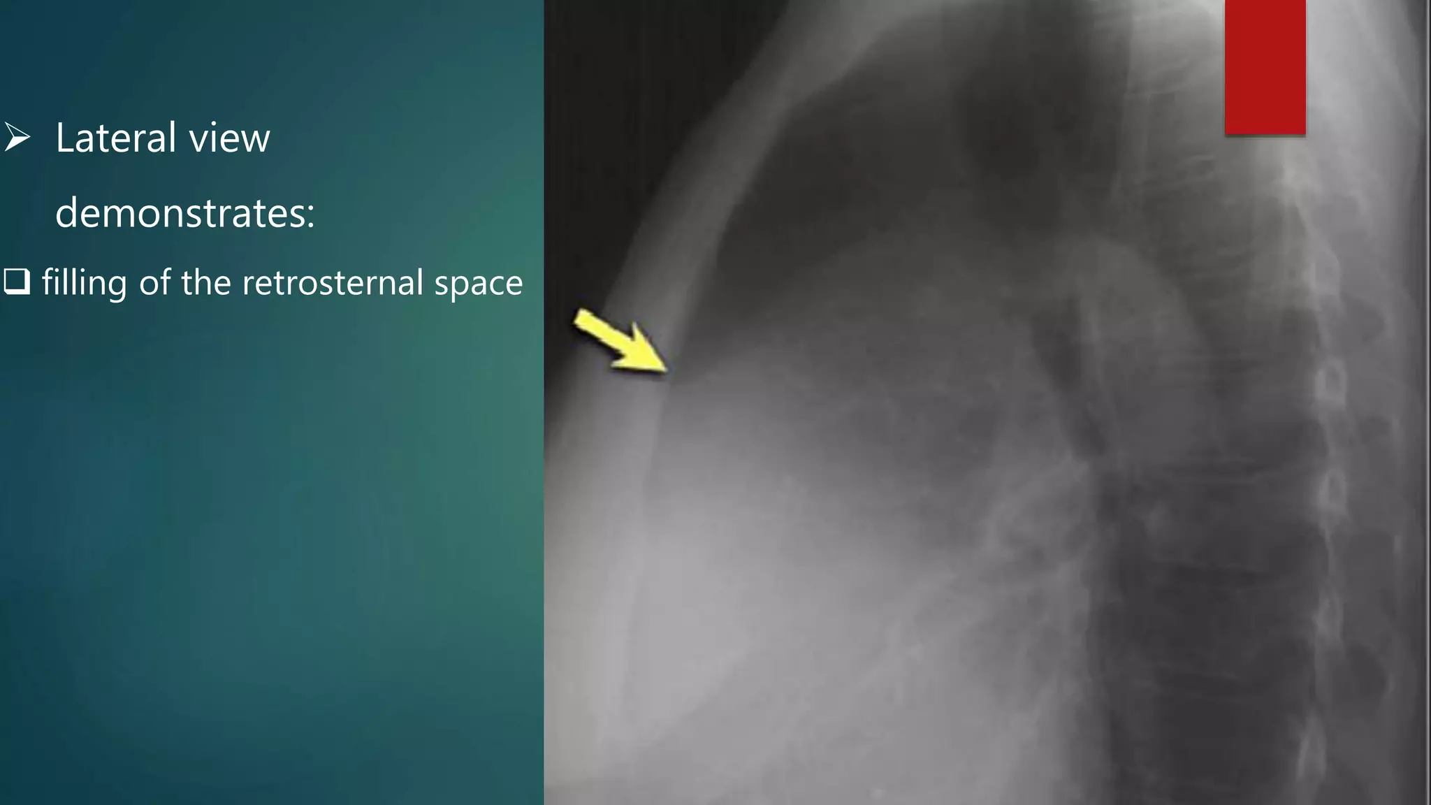 Valvular heart diseases imaging | PPTX