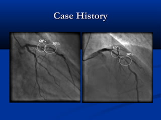 Pancoronary therapy with ipdd | PPT