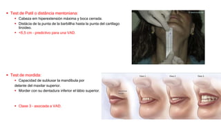 Vía Aérea - Anestesiología.pptxxxxxxx | PPTX