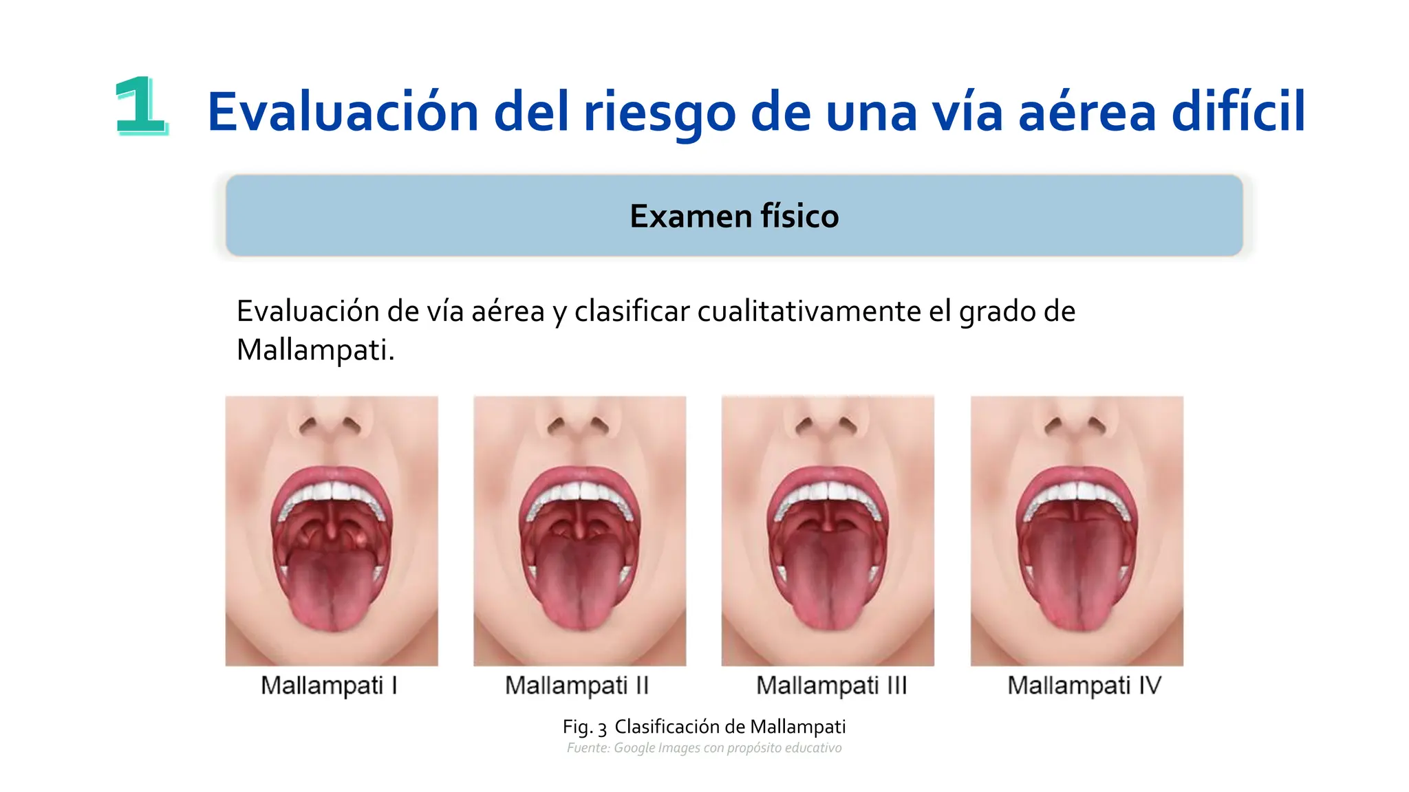 Vía Aérea Difícil Pptx