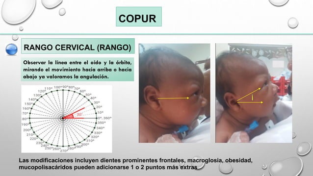 ESCALA DE COPUR VIA AEREA DIFICIL PEDIATRICA | PDF