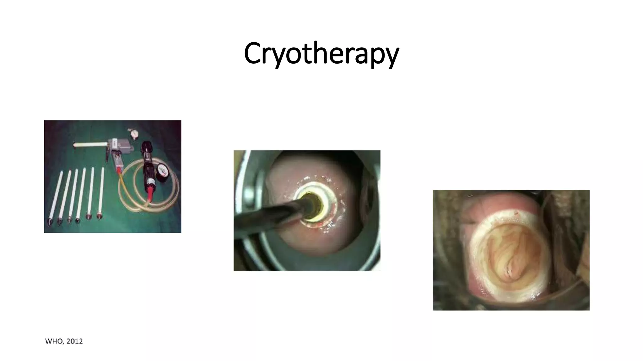 Visual Inspection with AceticAcid of the Cervix Uteri | PPTX