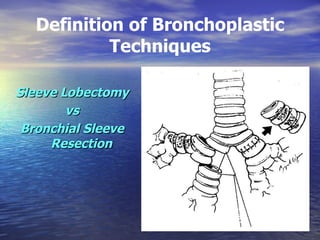 Lung Cancer: An Overview & Discussion of Minimally Invasive Surgical ...