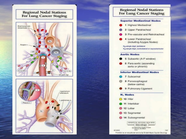 Lung Cancer: An Overview & Discussion of Minimally Invasive Surgical ...