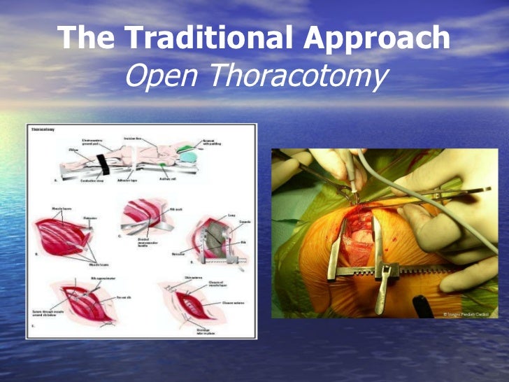Lung Cancer: An Overview & Discussion of Minimally Invasive Surgical