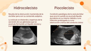 vias biliares/colecistitis aguda y crónica | PPTX
