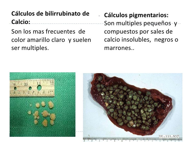Vias biliares y vesicula biliar