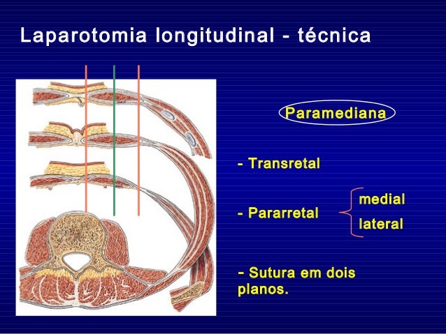 Aula - "Vias de Acesso à Cavidade Abdominal: laparotomia e videolapar…