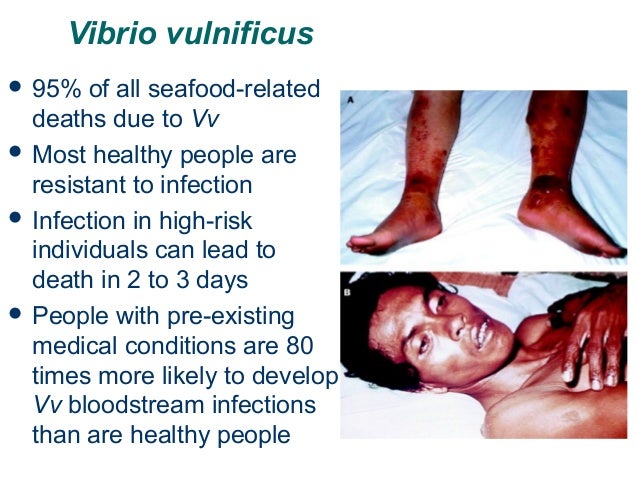 Vibrio vulnificus