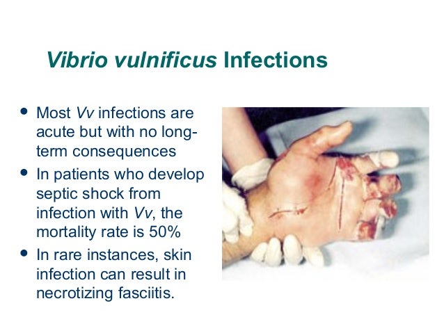 Vibrio vulnificus