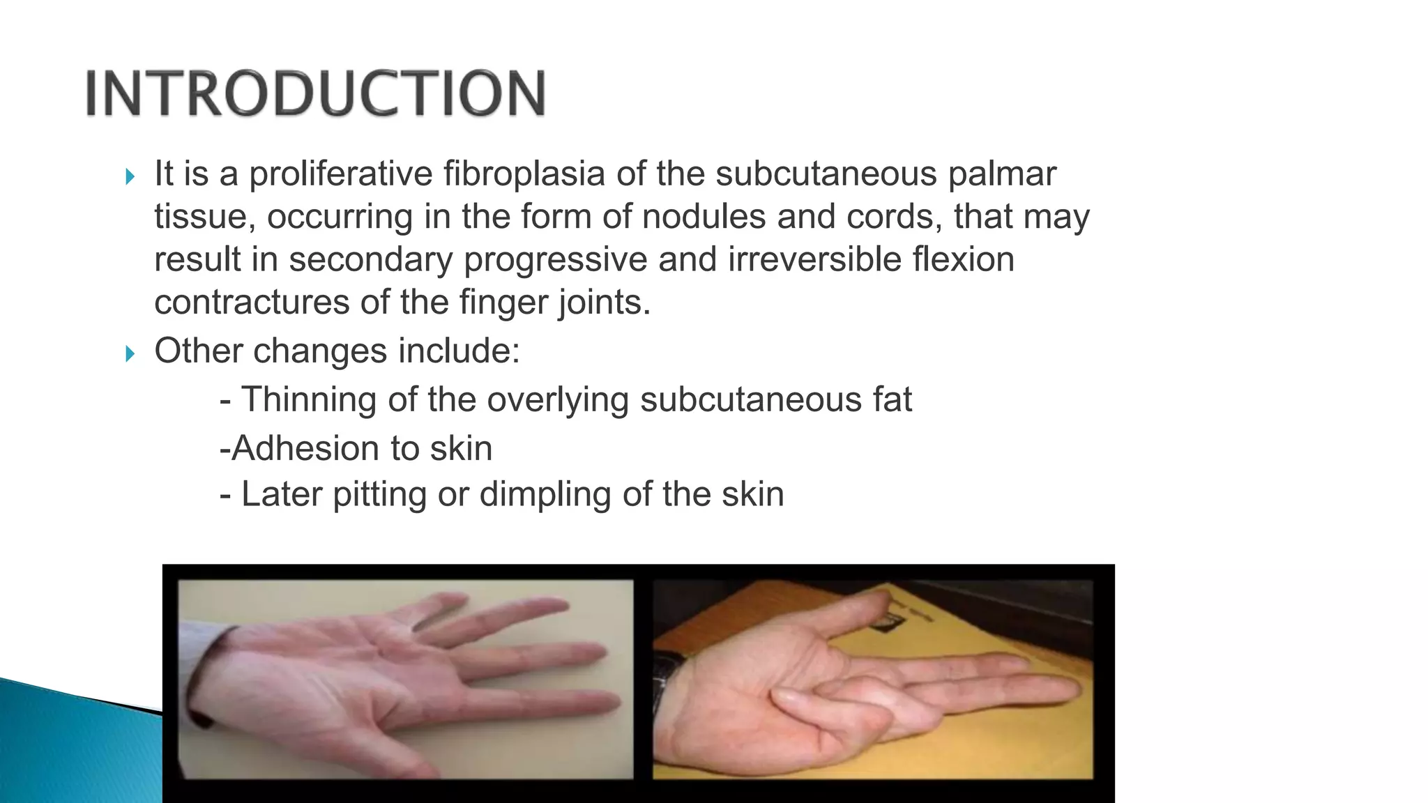 Dupuytren disease | PPTX