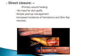 Dupuytren disease | PPTX